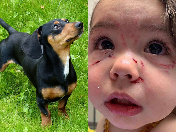 Dog Attacked Girl, Mum Shares Distraught Pictures - Boldsky.com