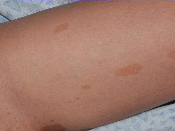 Neurofibromatosis – Types, Symptoms, Causes, Diagnosis and Treatment ...