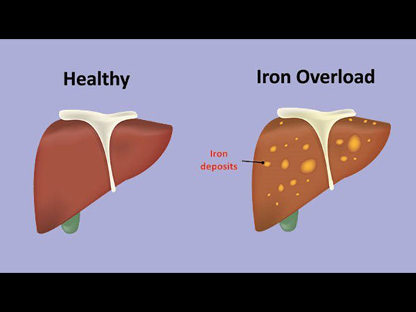 Haemochromatosis (Iron Overload): Types, Symptoms, Causes, Diagnosis ...