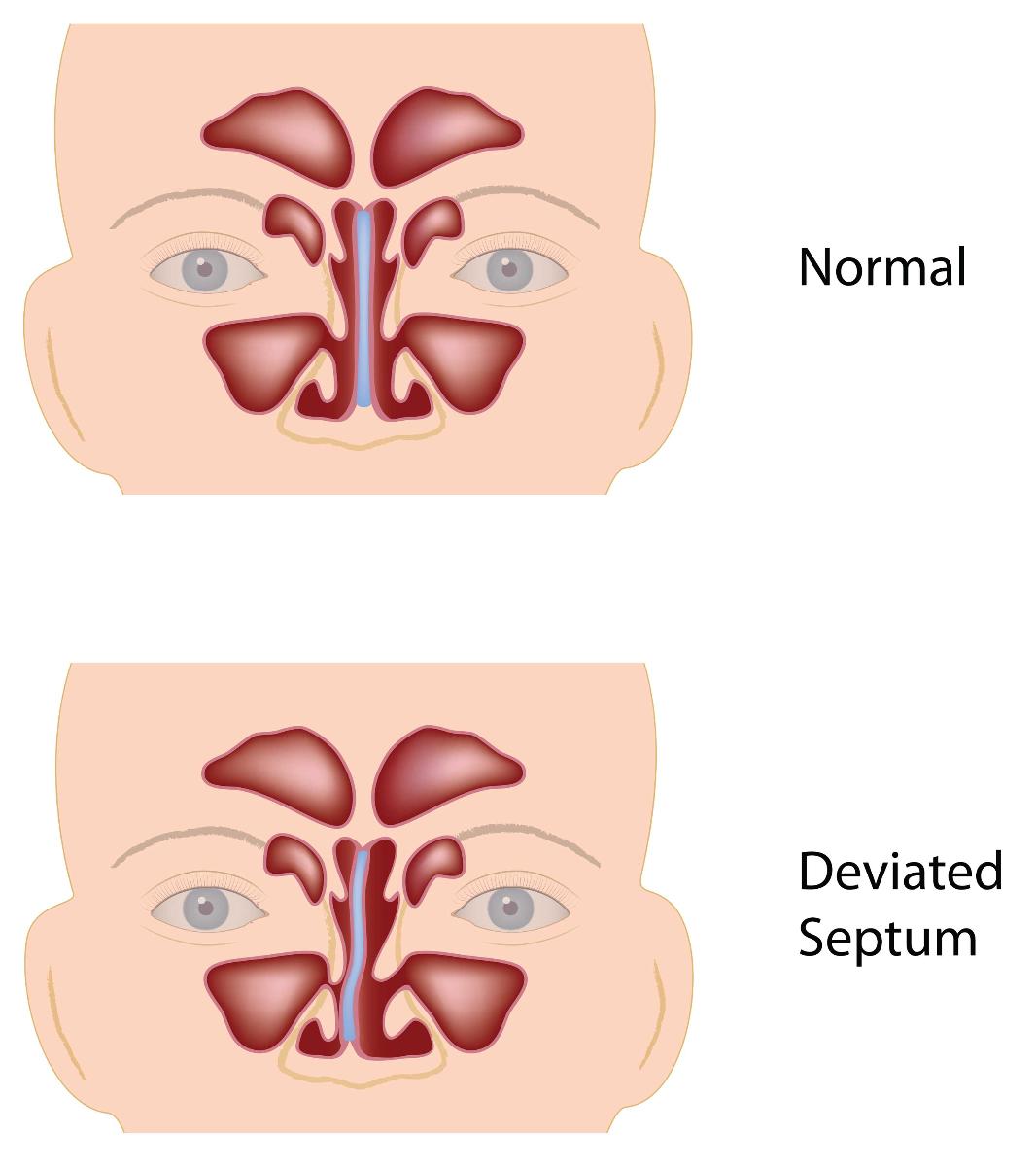 Deviated Nasal Septum: Symptoms, Causes And Treatment - Boldsky.com