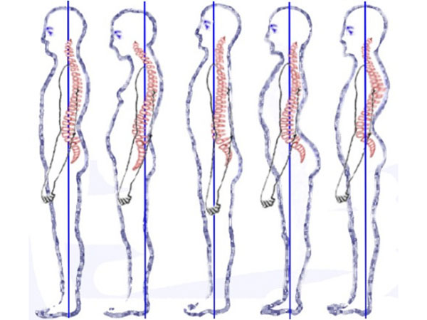 Rolfing Can Improve Posture, Reduce Stress And Relieve Chronic Pain ...
