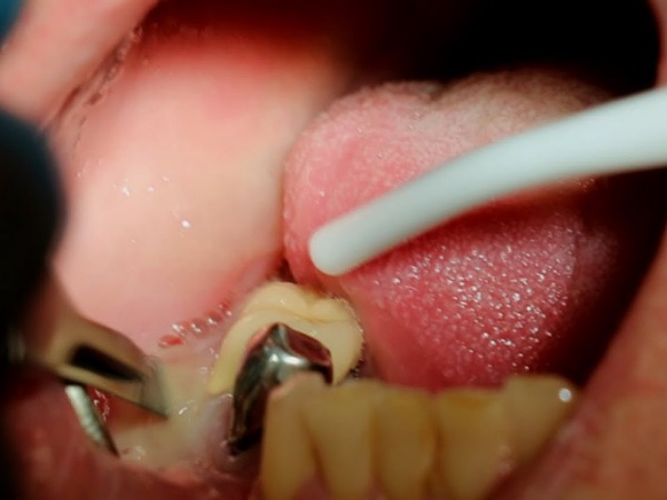 Abscessed Tooth (Dental Abscess): Symptoms, Types, Treatment ...