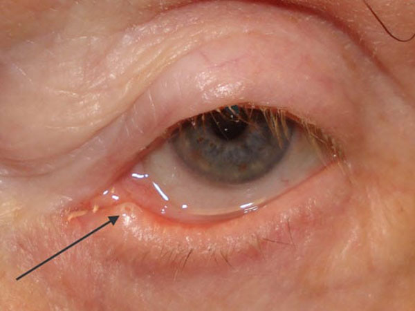 Epiphora (Watering Eyes) - Causes, Symptoms, Diagnosis And Treatment ...