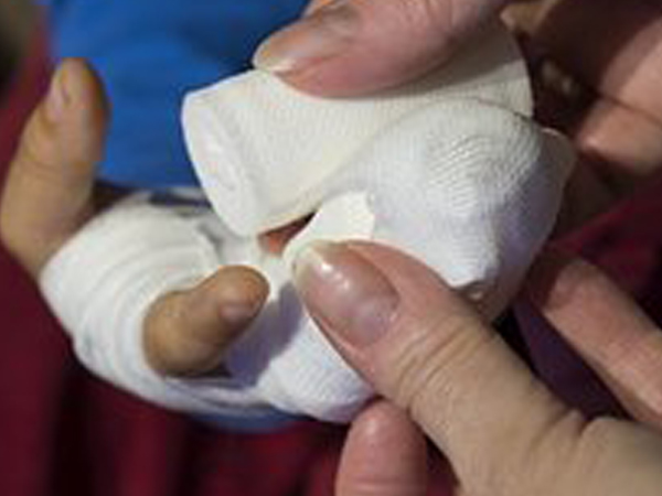 Compartment Syndrome: Causes, Symptoms, Diagnosis And Treatment ...