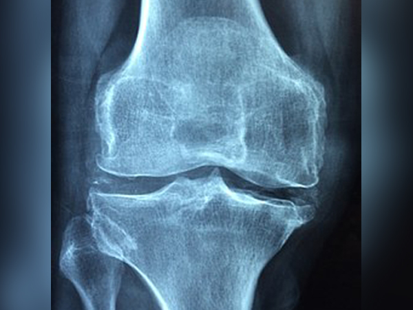 Pseudogout: Causes, Symptoms, Diagnosis And Treatment - Boldsky.com