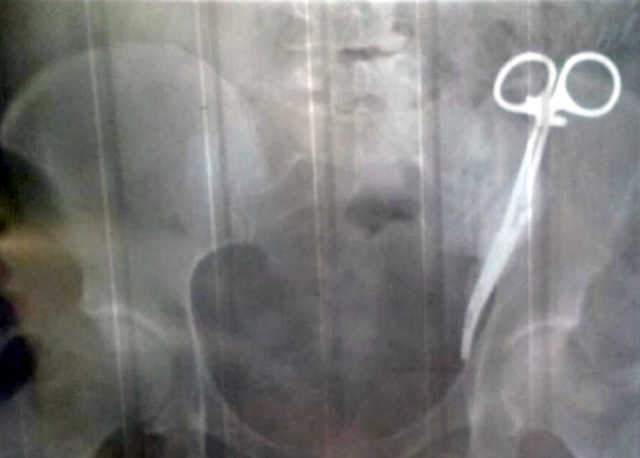 A Woman Had Surgical Clamp Lodged In Her Abdomen For 23 Years ...