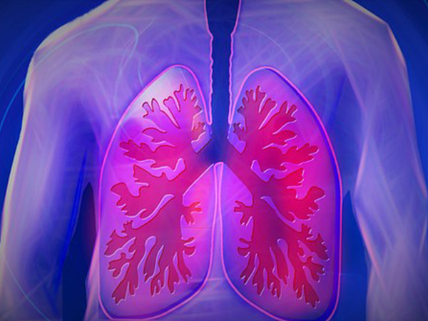 Bronchiectasis: Causes, Symptoms, Diagnosis And Treatment - Boldsky.com