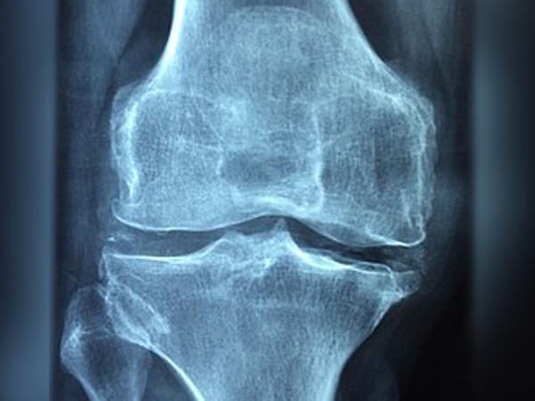 Hyperphosphatemia: Symptoms, Causes, Diagnosis And Treatment - Boldsky.com