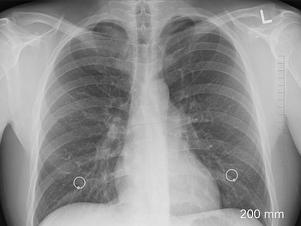 Pericarditis: Causes, Symptoms, Diagnosis And Treatment - Boldsky.com