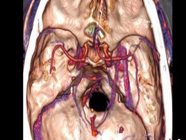 Man Had Wooden Splinters Stuck In His Head For 5 Years! - Boldsky.com