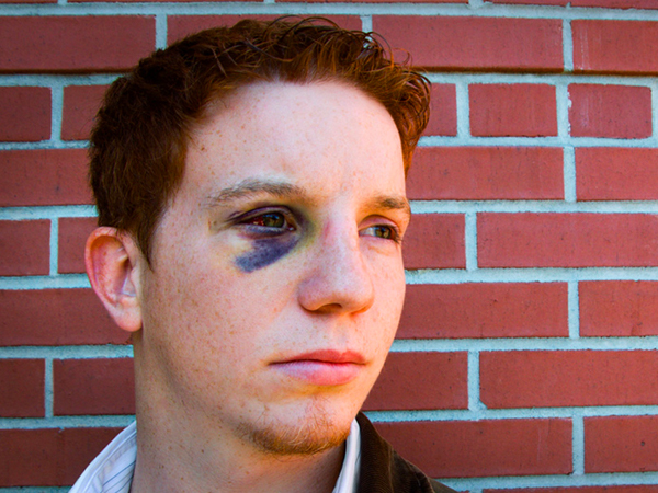 Black Eye: Causes, Symptoms, Diagnosis & Treatment - Boldsky.com