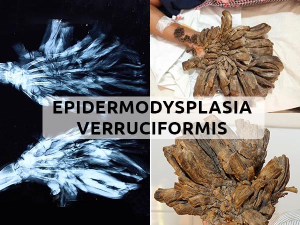Epidermodysplasia Verruciformis (EV): Causes, Symptoms, Diagnosis And ...