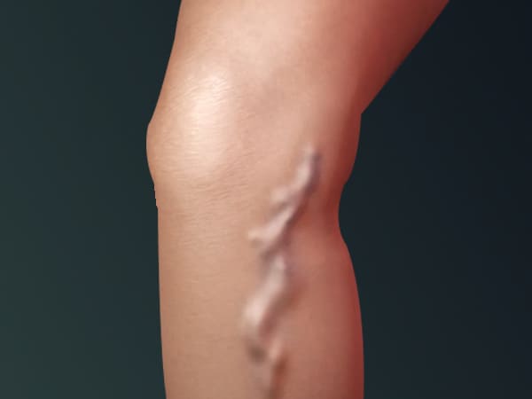Phlebitis Causes Symptoms Diagnosis And Treatment