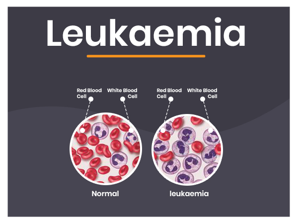 Leukemia Cells Vs Normal Cells