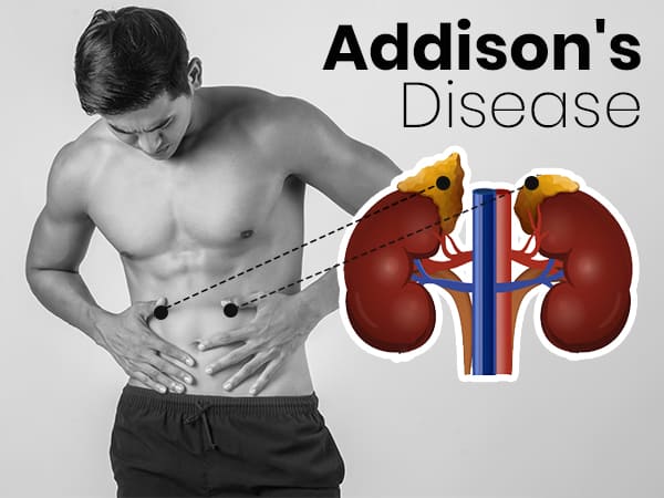 Addison's Disease: Symptoms, Causes, Risk Factors And Treatment ...