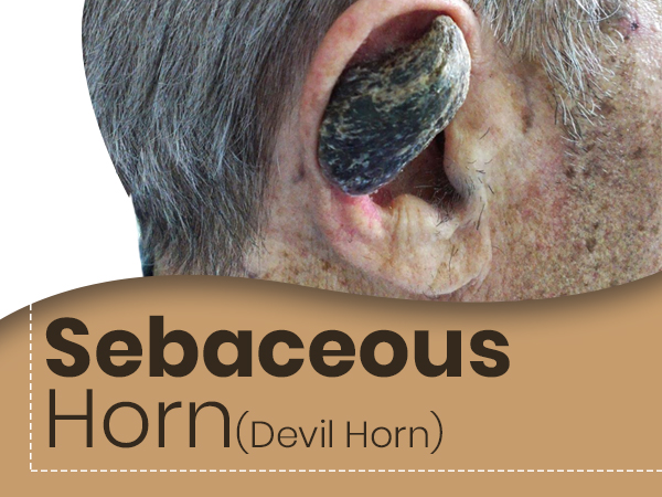 Sebaceous Horn (Devil’s Horn): Causes, Symptoms, Risk Factors ...