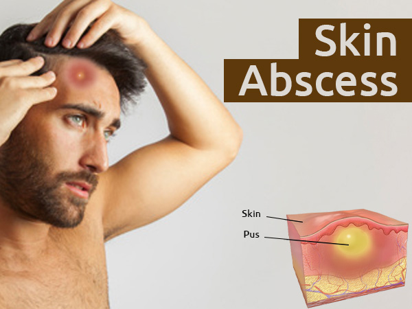 Skin Abscess: Causes, Symptoms, Diagnosis, Prevention And Treatment - Boldsky.com