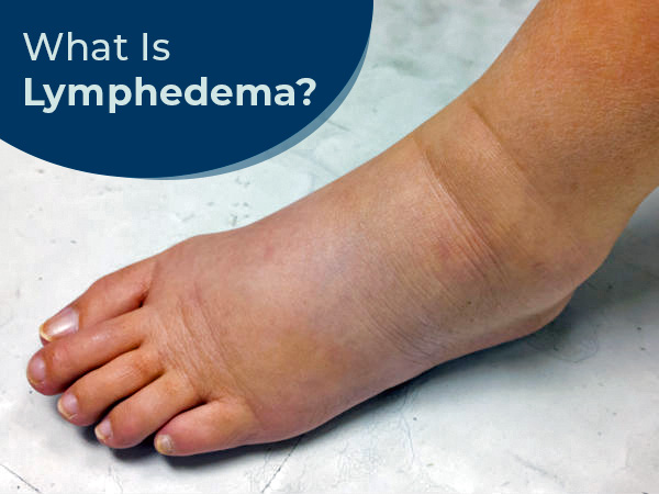 Lymphedema (Lymphatic Dysfunction): Types, Causes, Symptoms, Risk ...