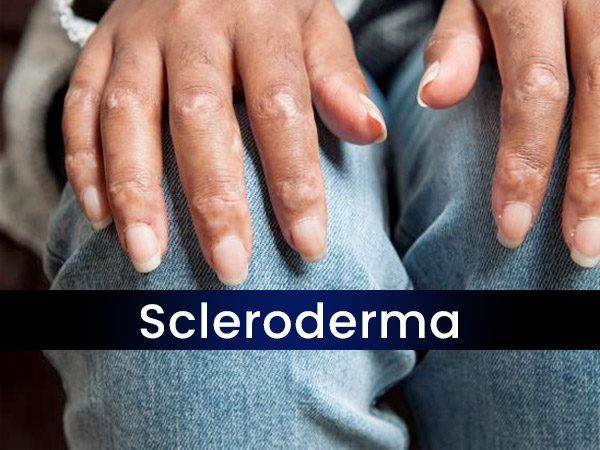 Scleroderma: Types, Causes, Symptoms, Diagnosis, Treatment And ...