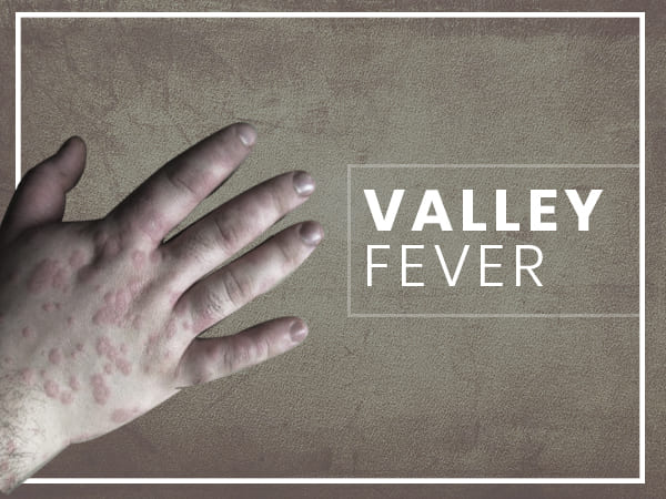 Valley Fever: Causes, Symptoms, Risk Factors, Diagnosis And Treatment ...