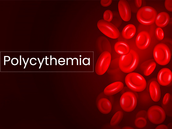 Polycythemia: Causes, Symptoms, Risk Factors, Diagnosis, Treatment And ...