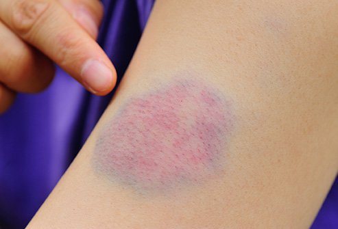 6 Signs And Symptoms Of Blood Clot - Boldsky.com