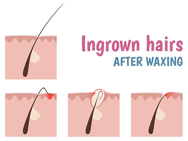Side Effects Of Waxing You Should Know About - Boldsky.com