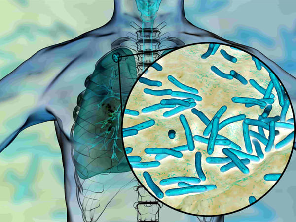 World Tuberculosis Day 2021: Causes, Symptoms & Treatment Of ...