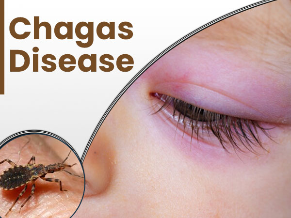 Chagas Disease: Causes, Symptoms, Risk Factors, Treatment And ...