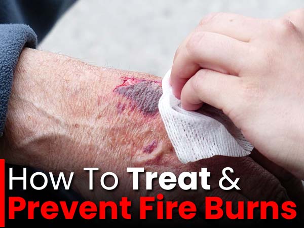 Fire Burns: Treatment And Prevention Tips - Boldsky.com