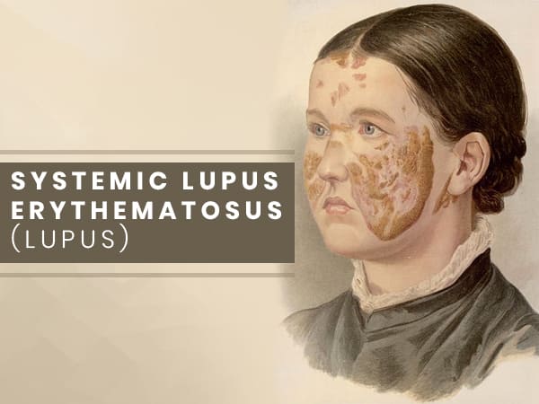 Systemic Lupus Erythematosus: Causes, Symptoms, Complications ...
