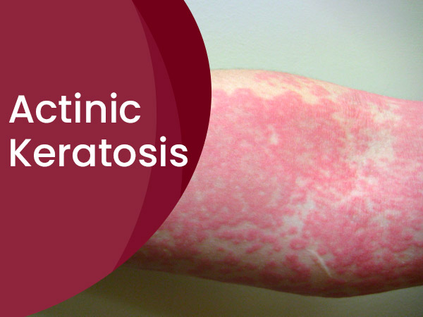 Actinic Keratosis: Causes, Symptoms, Risk Factors, Treatments And ...