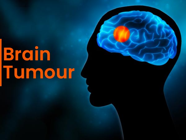 Brain Tumour: Types, Causes, Symptoms, Risk Factors, Diagnosis And ...