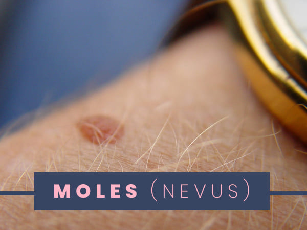 Moles: Types, Causes, Symptoms, Risk Factors, Treatments And Prevention ...