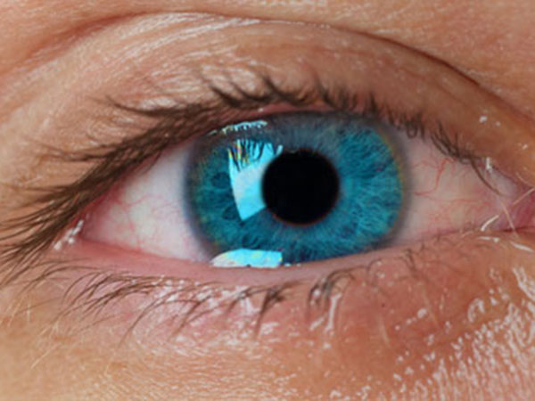 Stye (Lump On The Eyelid): Causes, Symptoms, Risk Factors, Complication ...