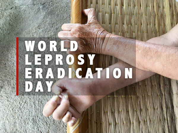 Leprosy: Types, Causes, Diagnosis & Treatment - Boldsky.com