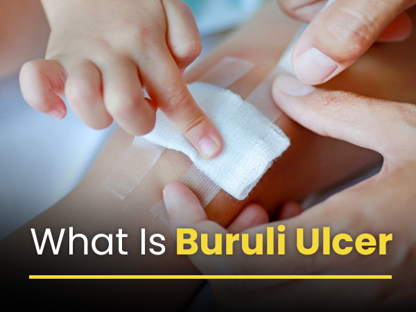 What To Know About Buruli Ulcer, Flesh-Eating Disease Spreading In ...