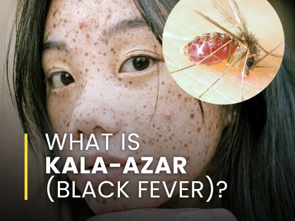What Is Kala-Azar (Black Fever)? Causes, Symptoms, Risk Factors ...