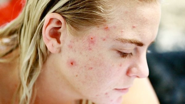 What Happens If Testosterone Is High In Women? Causes, Symptoms And ...