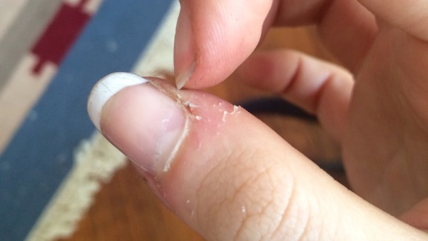 Do You Often Pick The Skin Around Nails? You May Have Excoriation Or ...