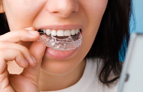 What Are Teeth Aligners? Benefits, Risks And Who Should Get It ...