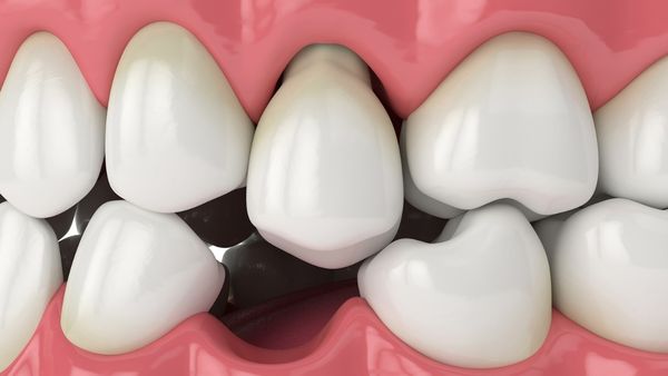 Expert Article On Loose Teeth: When Should You Be Worried About Your ...