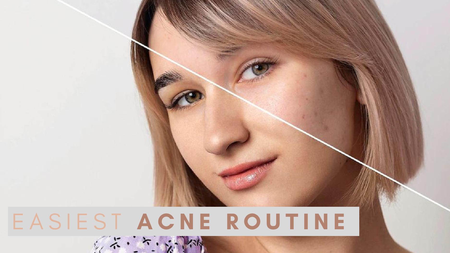 Easiest Acne Routine For Everyone - Boldsky.com