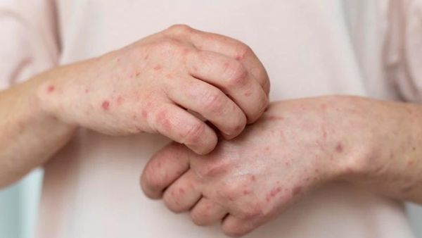 Lupus: What Causes This Autoimmune Condition? Types, Symptoms ...