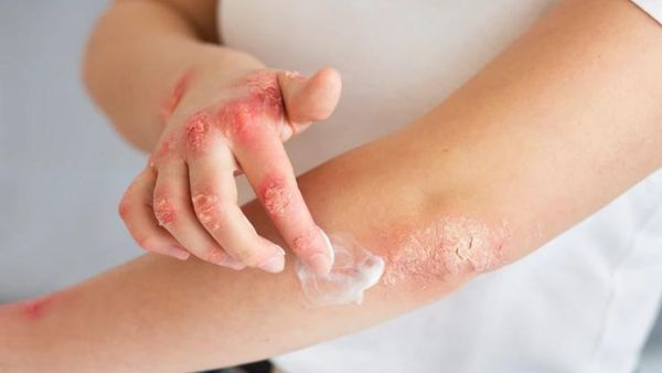 Lupus: What Causes This Autoimmune Condition? Types, Symptoms ...