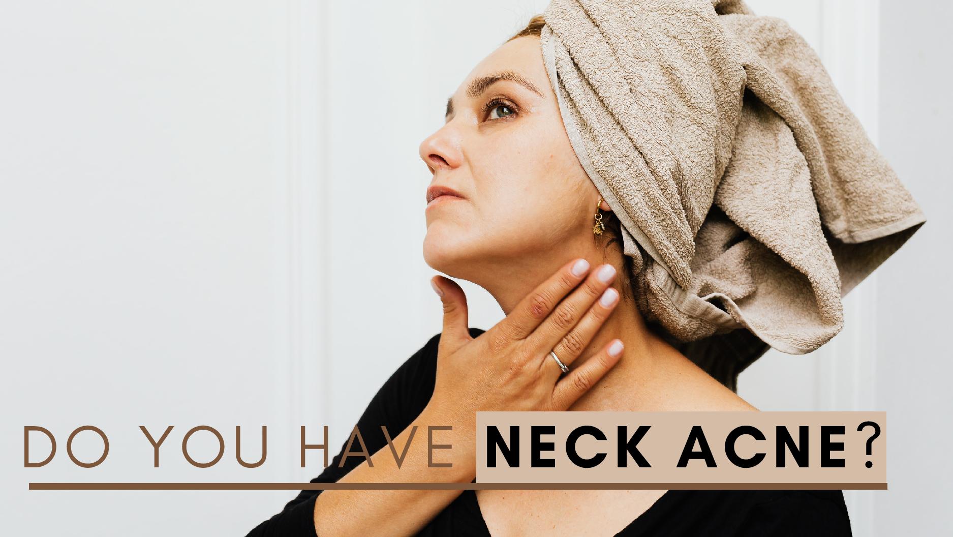 Do You Have Neck Acne? Here's How You Can Get Rid Of It! - Boldsky.com