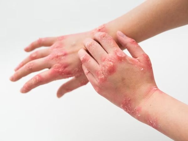 Rare Skin Disorder Causes Skin To Peel Off 10 Times Faster ...