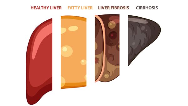 Japanese Diet To Prevent Fatty Liver Disease - Boldsky.com