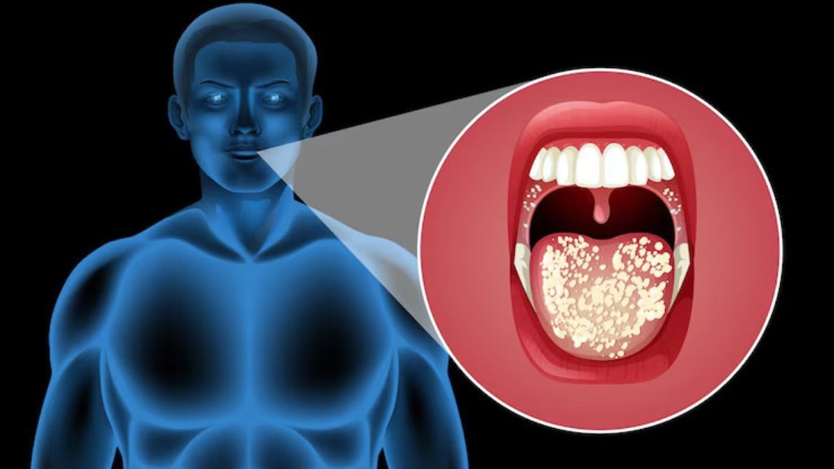 Oral Cancer: Early Detection, Diagnosis And Staging - Boldsky.com
