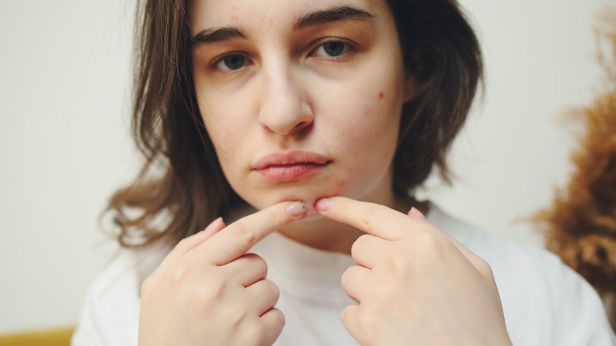 Guide to Post-Pimple Popping Care and Scar Prevention - Boldsky.com